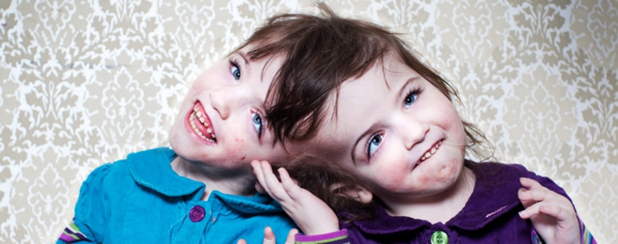 De Siamese tweeling die de wetenschap met verstomming slaat | Humo